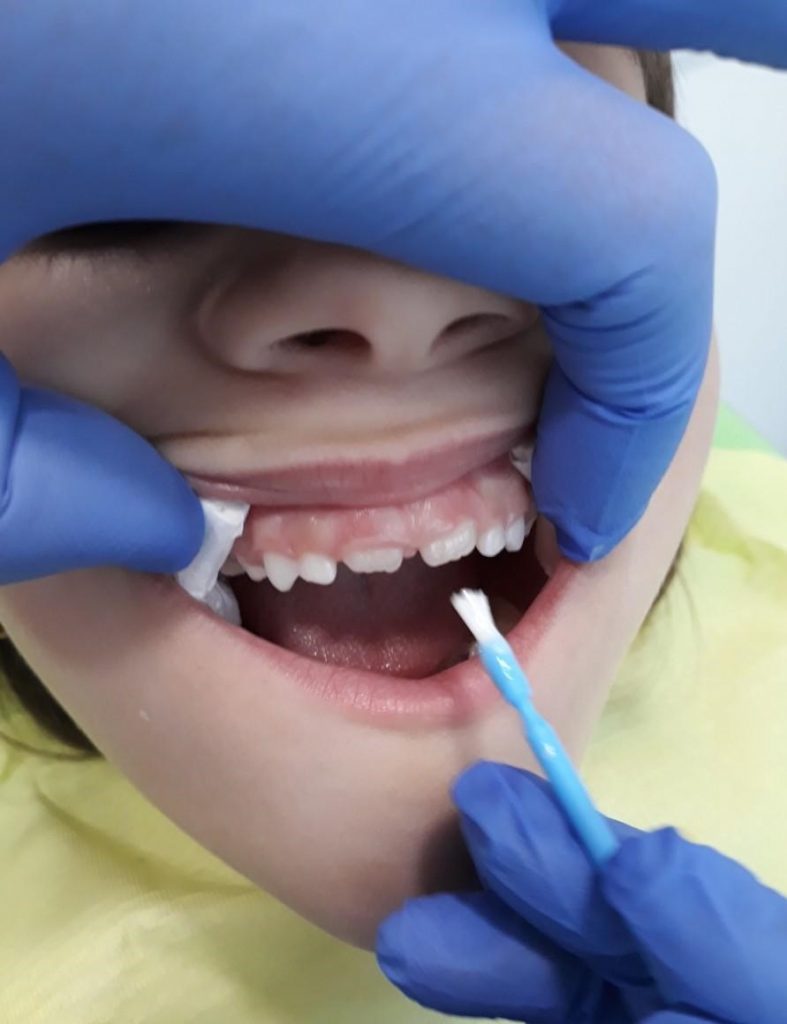 Fluorizacija - korak ka većoj zaštiti zuba - Ardent Centar ...