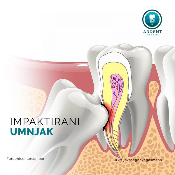 Impaktirani umnjak - Ardent Dental Centar - Stomatološka ordinacija